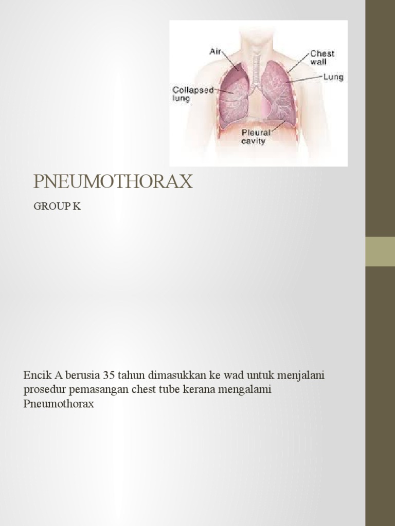 Pneumothorax | PDF