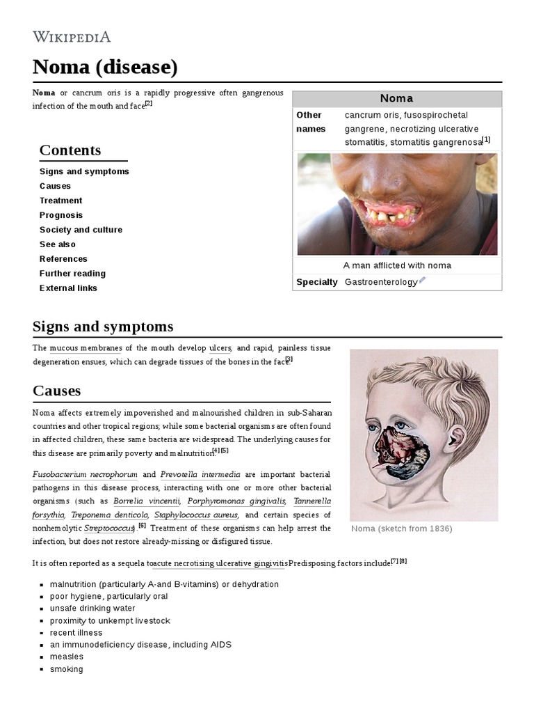 Noma Cancrum Oris | PDF | Clinical Medicine | Diseases And Disorders