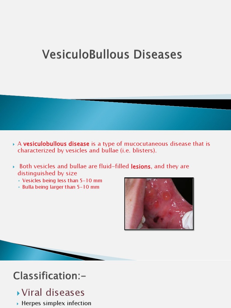 Ve Siculo Bull Ous Diseases | PDF | Herpes Simplex | Cutaneous Conditions