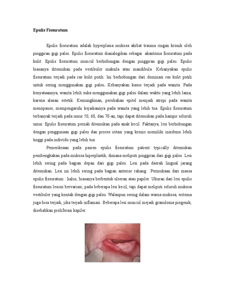 Epulis Fissuratum: Penyebab dan Penanganan | PDF | Kajian Bahasa Asing ...