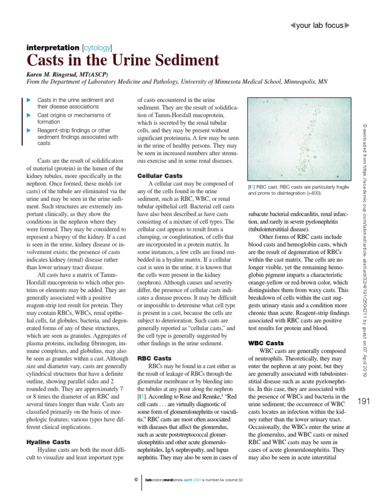 Cast in Urine Sediment | PDF | Nephrology | Medical Specialties