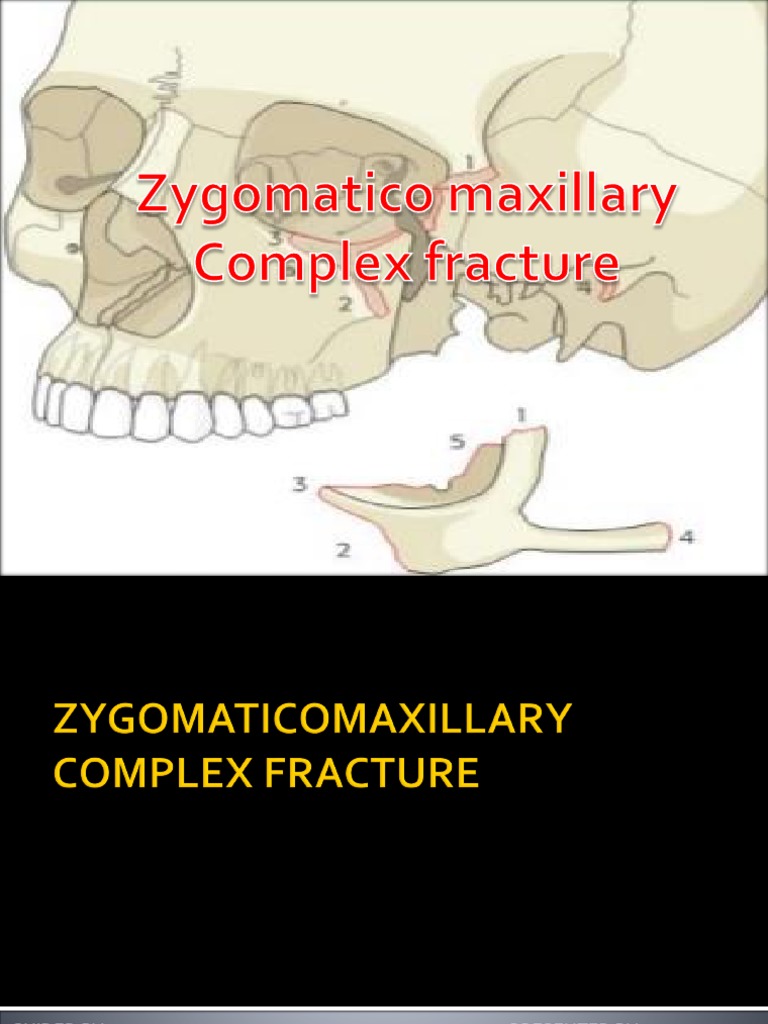 Zygomaticomaxillary Complex Fracture Guide | PDF | Human Anatomy ...