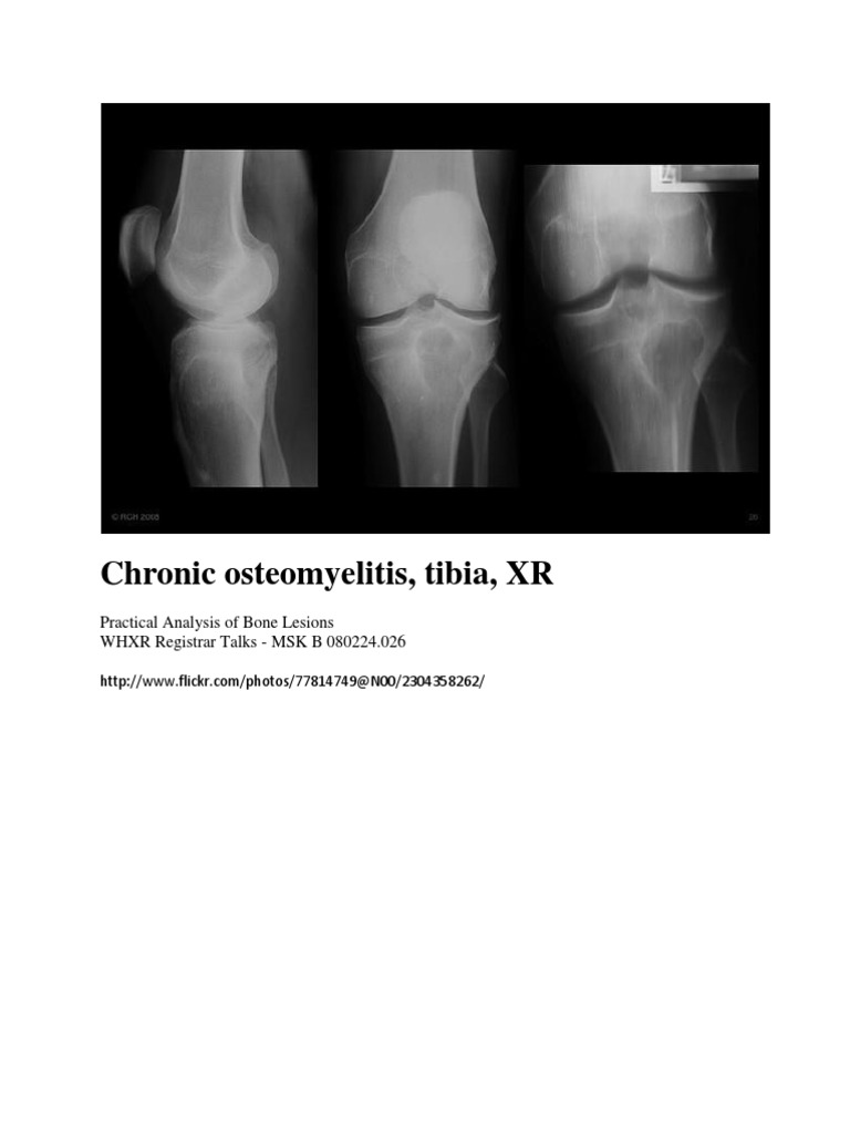 Chronic Osteomyelitis, Tibia, XR: Practical Analysis of Bone Lesions ...