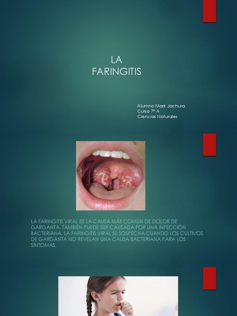 La Faringitis | PDF