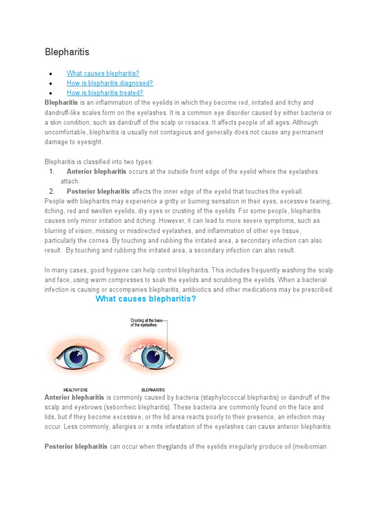 Blepharitis: What Causes Blepharitis? How Is Blepharitis Diagnosed? How ...