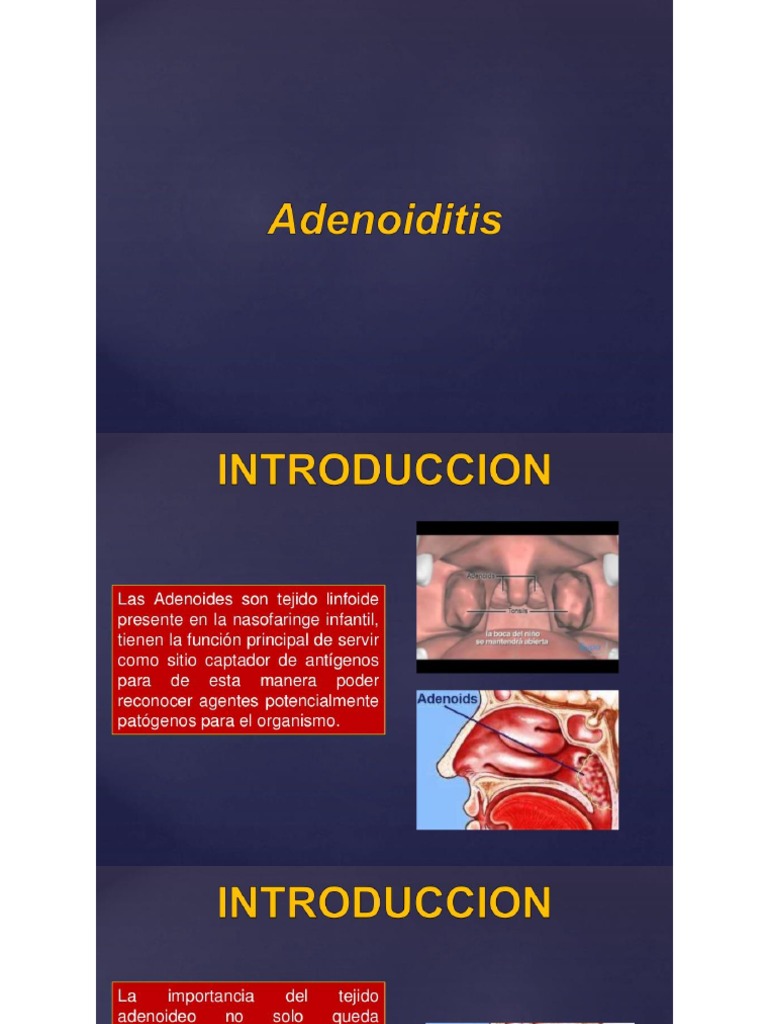 Adenoiditis | PDF