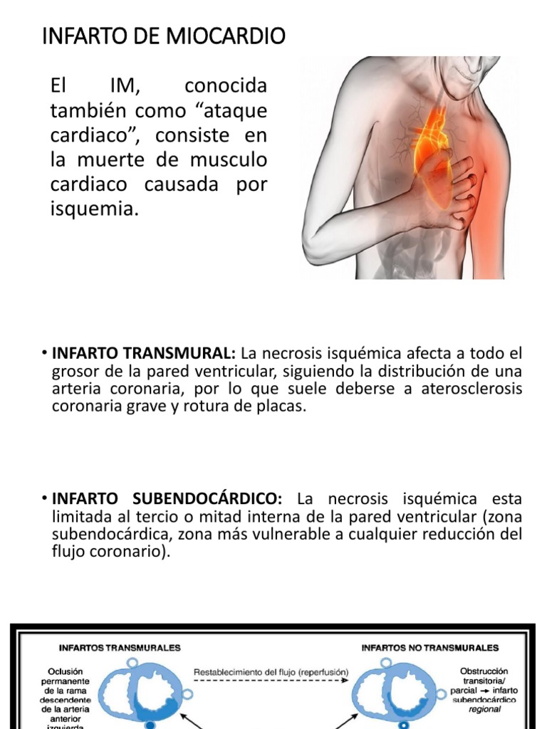 Infarto Transmural y Subendocárdico | PDF | Infarto de miocardio | Isquemia