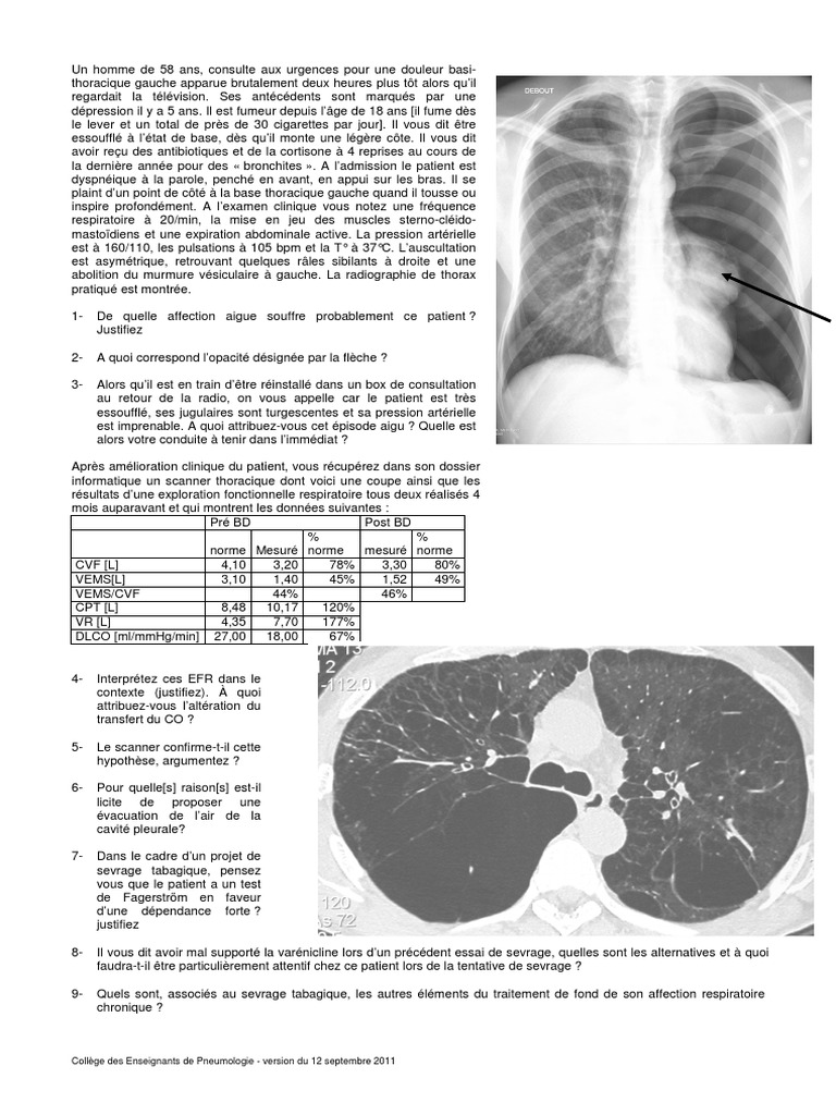 Pneumothorax compressif et BPCO | PDF | Système respiratoire | Médecine ...