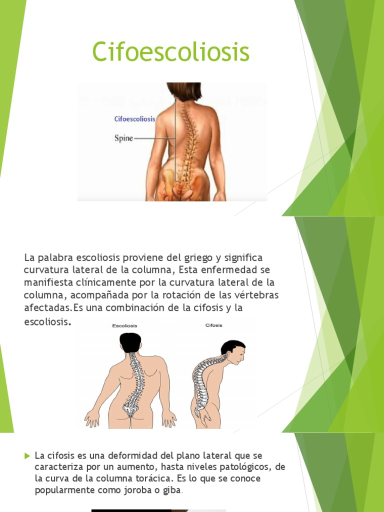 Cifoescoliosis: Tipos y Tratamientos | PDF | Relaciones personales ...