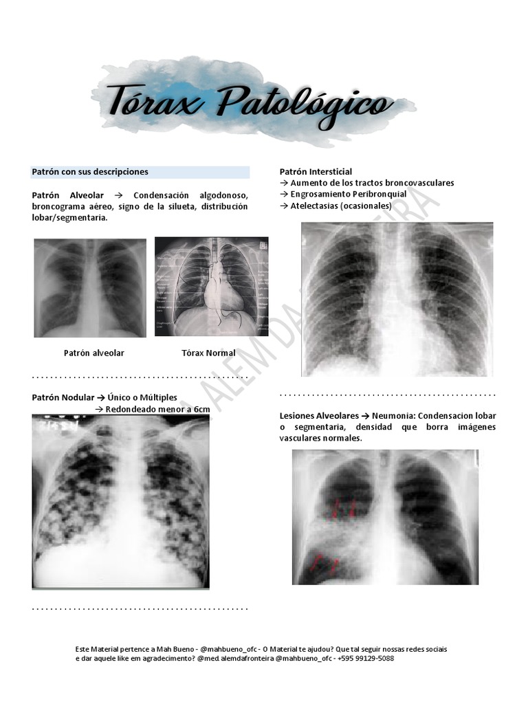 Medicina Por Imagens - Tórax Patológico | PDF | Pulmón | Sistema ...