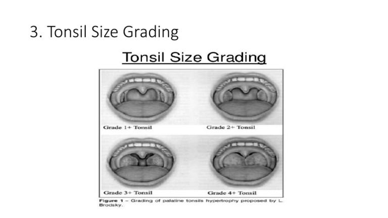 3 Grading Tonsil | PDF