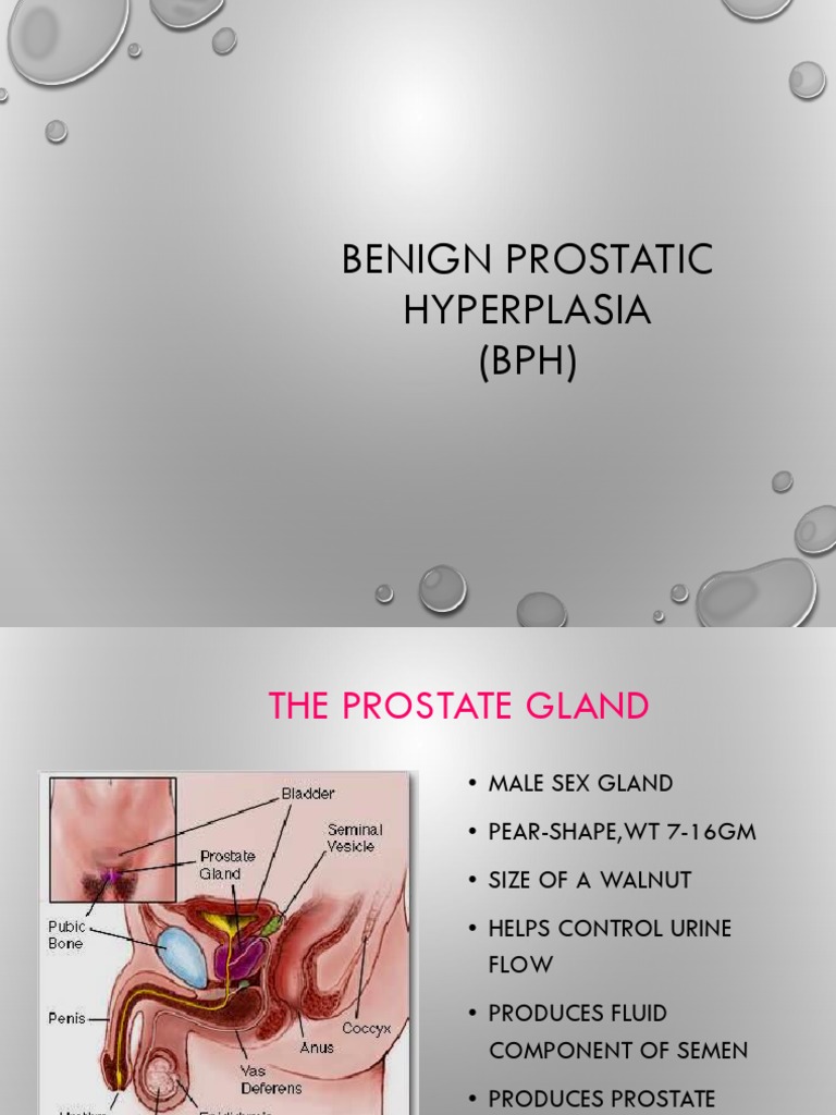 Understanding Benign Prostatic Hyperplasia: A Comprehensive Review of ...
