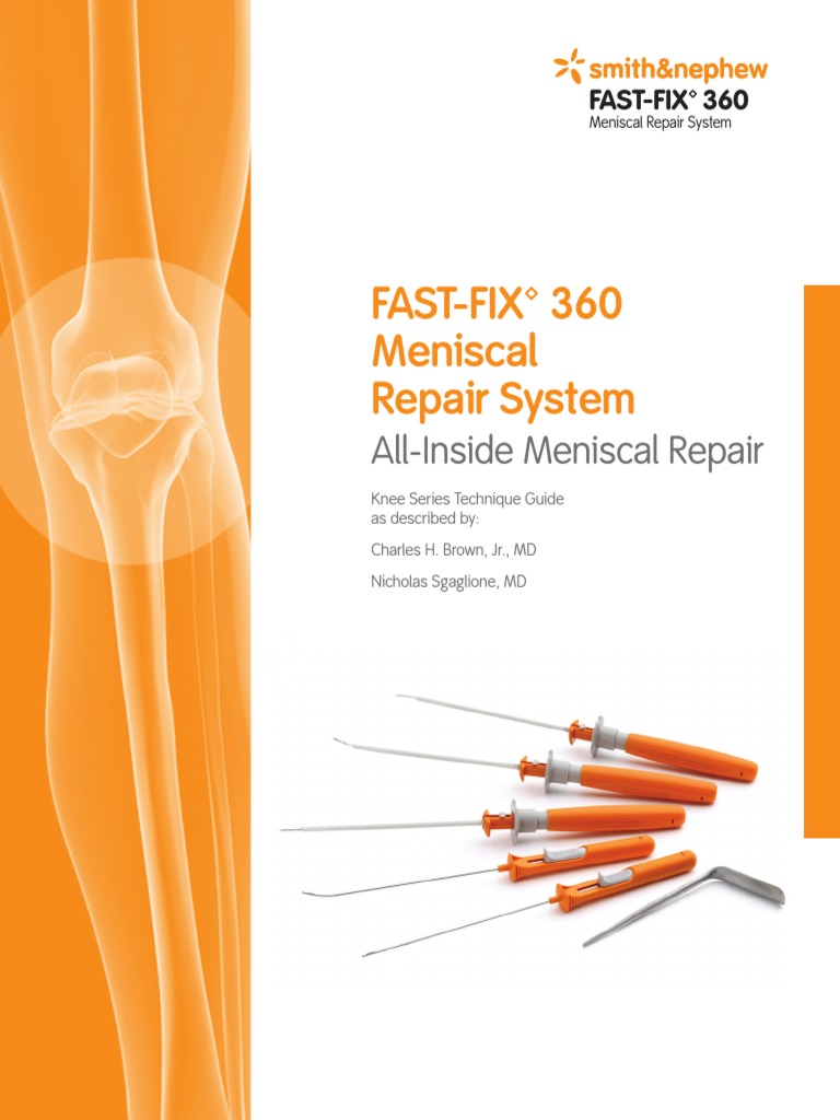 FAST-FIX™ 360 Meniscal Repair System | PDF | Surgical Suture | Knee