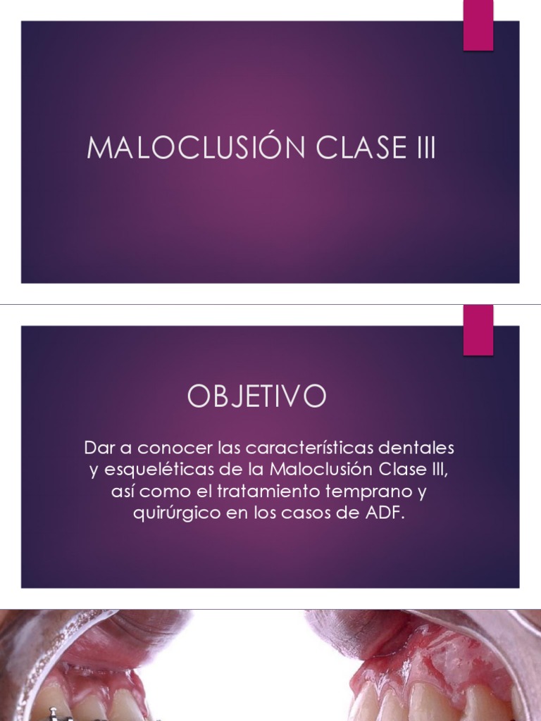 Maloclusión Clase III: Diagnóstico y Tratamiento | PDF | Ortodoncia | Cara