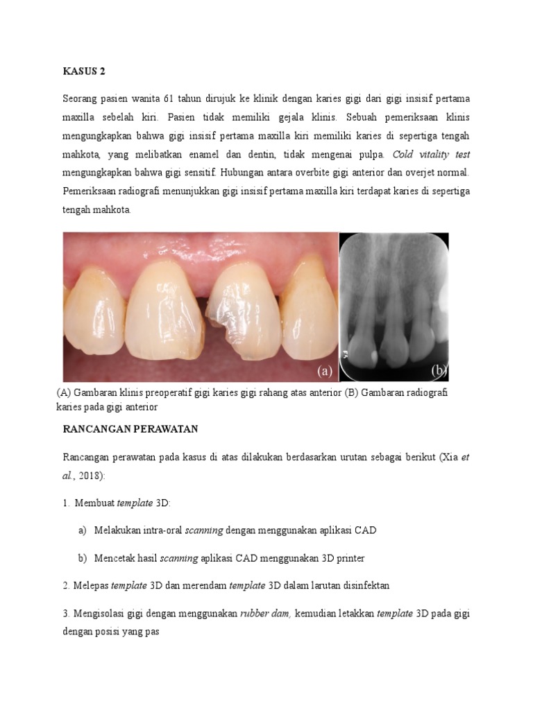 Restorasi Gigi Insisif dengan Template 3D | PDF