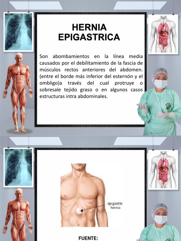 Hernia Epigastrica | PDF | Abdomen | Anatomía
