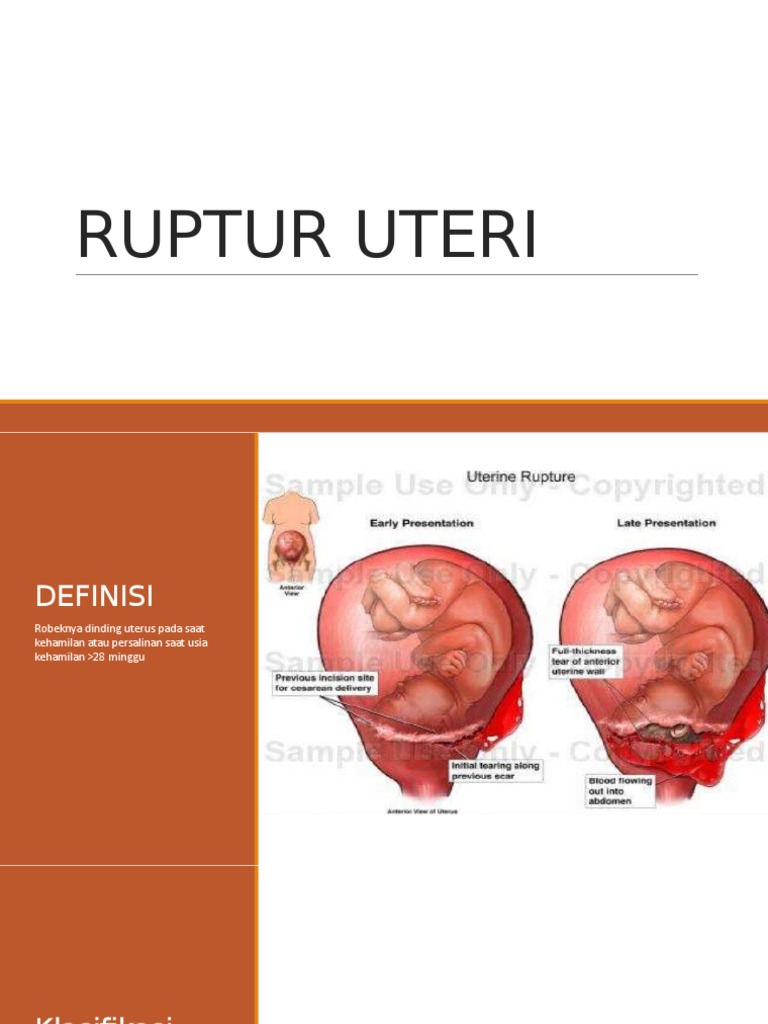 CSS - Ruptur Uteri | PDF