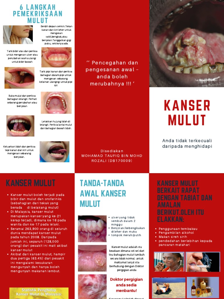 Kanser Mulut | PDF