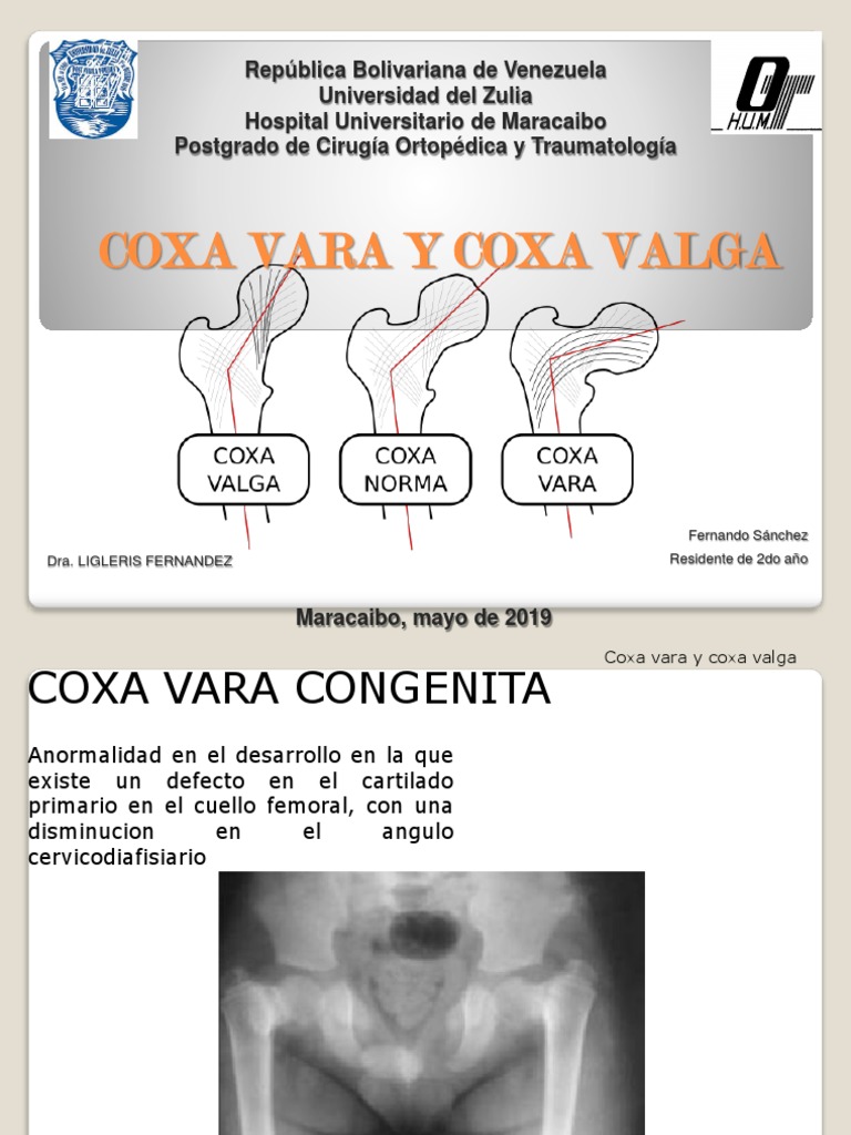 Coxa Vara y Coxa Valga Fernando | Traumatologia | Sistema ...