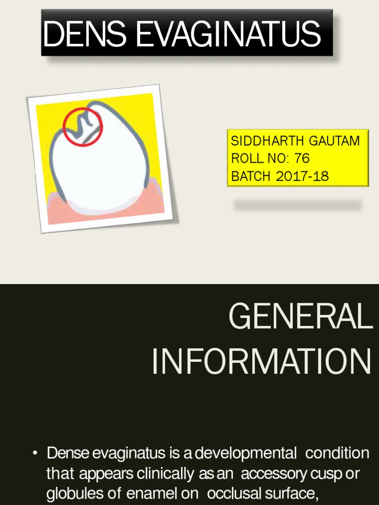 Dens Evaginatus: Siddharth Gautam Roll No: 76 BATCH 2017-18 | PDF ...