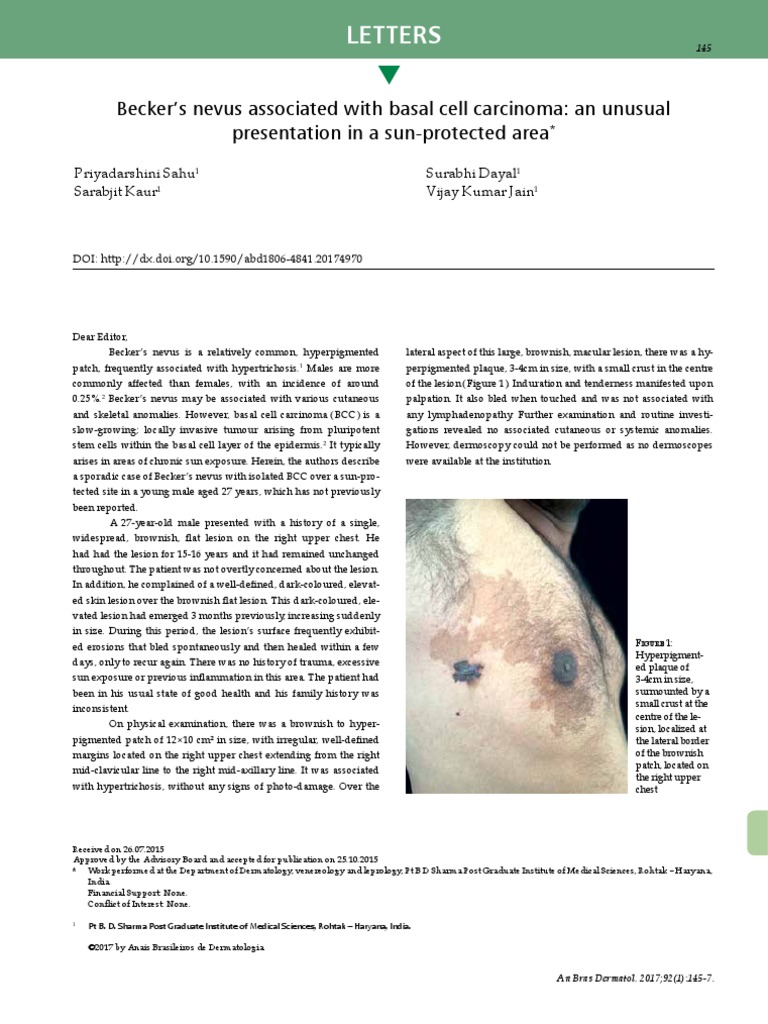 Becker's Nevus Associated With Basal Cell Carcinoma: An Unusual ...