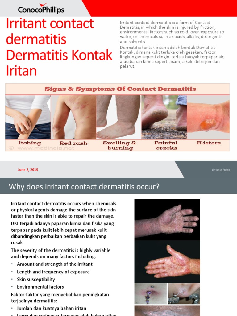 Irritant Contact Dermatitis Dermatitis Kontak Iritan: June 2, 2019 ...