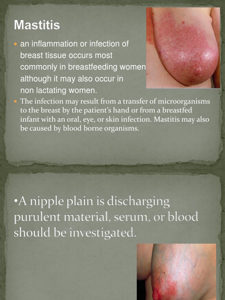 Mastitis In Women Symptoms