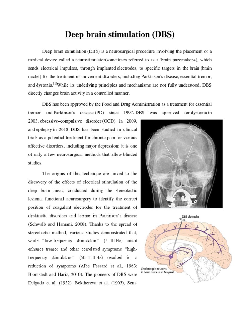 Deep Brain Stimulation | PDF | Deep Brain Stimulation | Clinical Medicine
