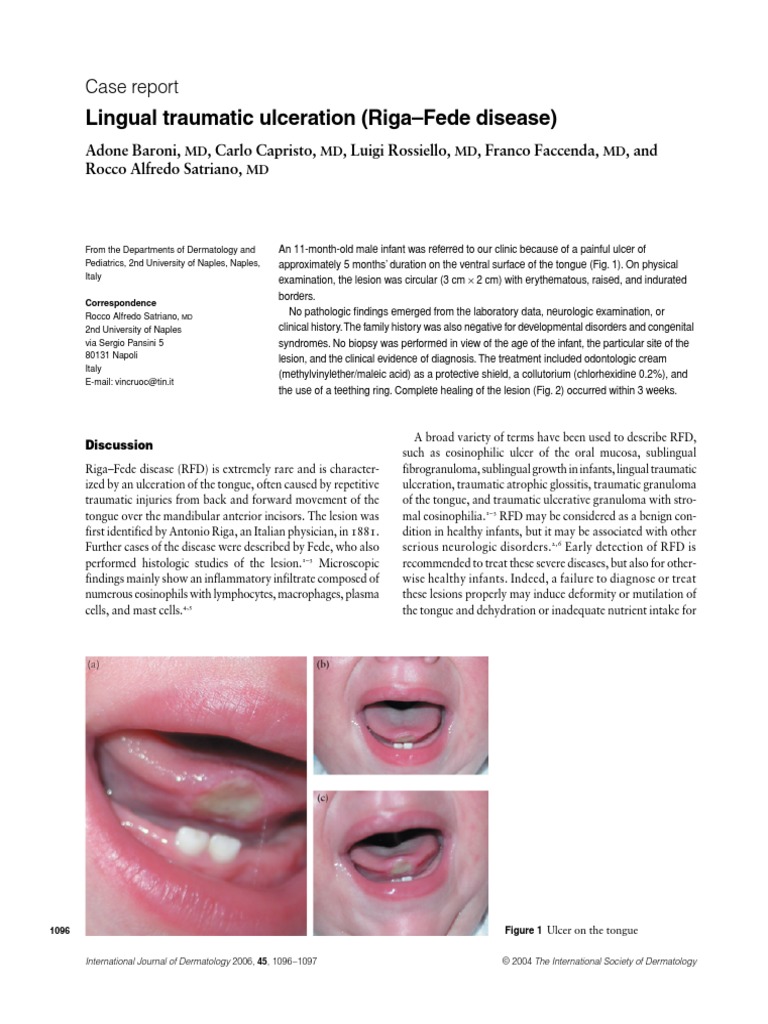 Lingual Traumatic Ulceration (Riga-Fede Disease) : Case Report | PDF ...