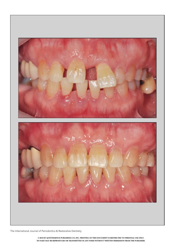 The International Journal of Periodontics & Restorative Dentistry | PDF ...