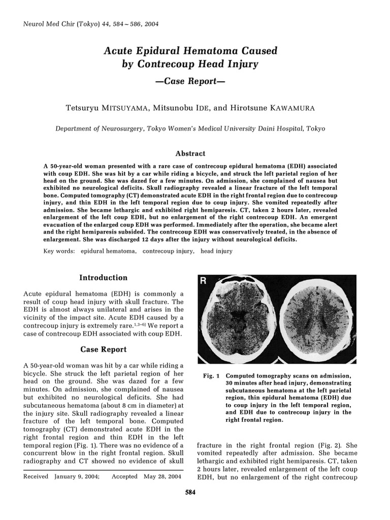 Kasus Acute Epidural Hematome Caused by Contrecoup Head Injury | PDF ...