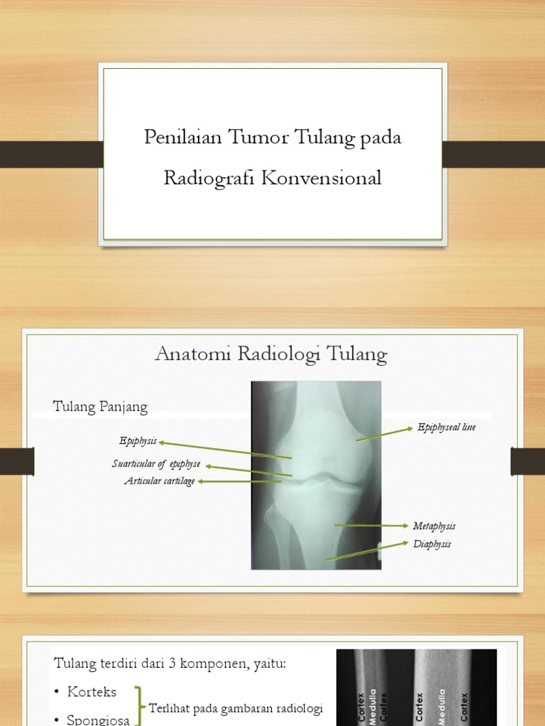 Tumor Tulang Pada Radiologi | PDF