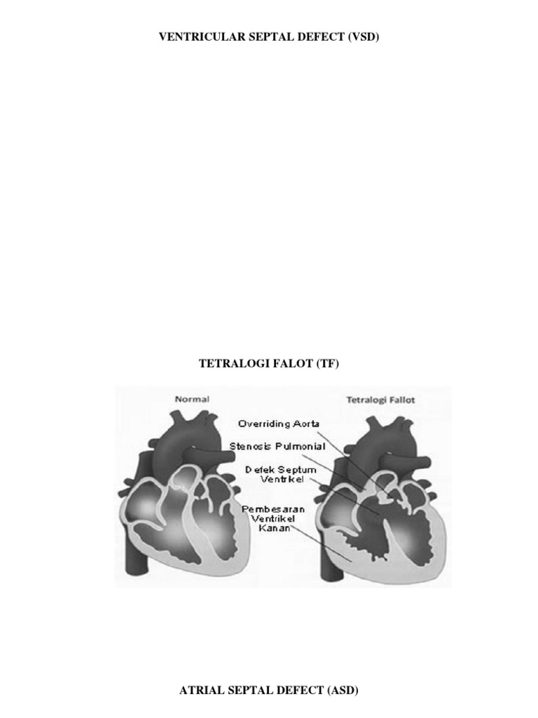 Ventricular Septal Defect (VSD) | PDF