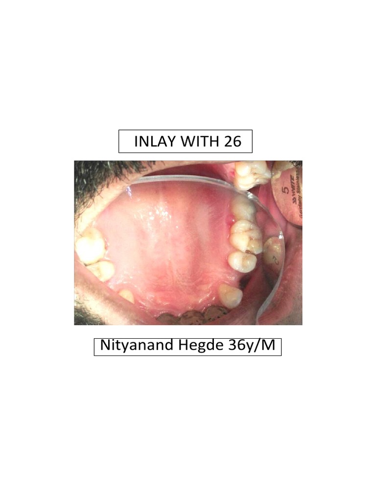 INLAY Final | PDF