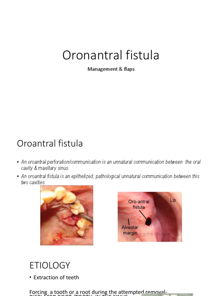 Oroantral Fistula | PDF | Mouth | Human Head And Neck