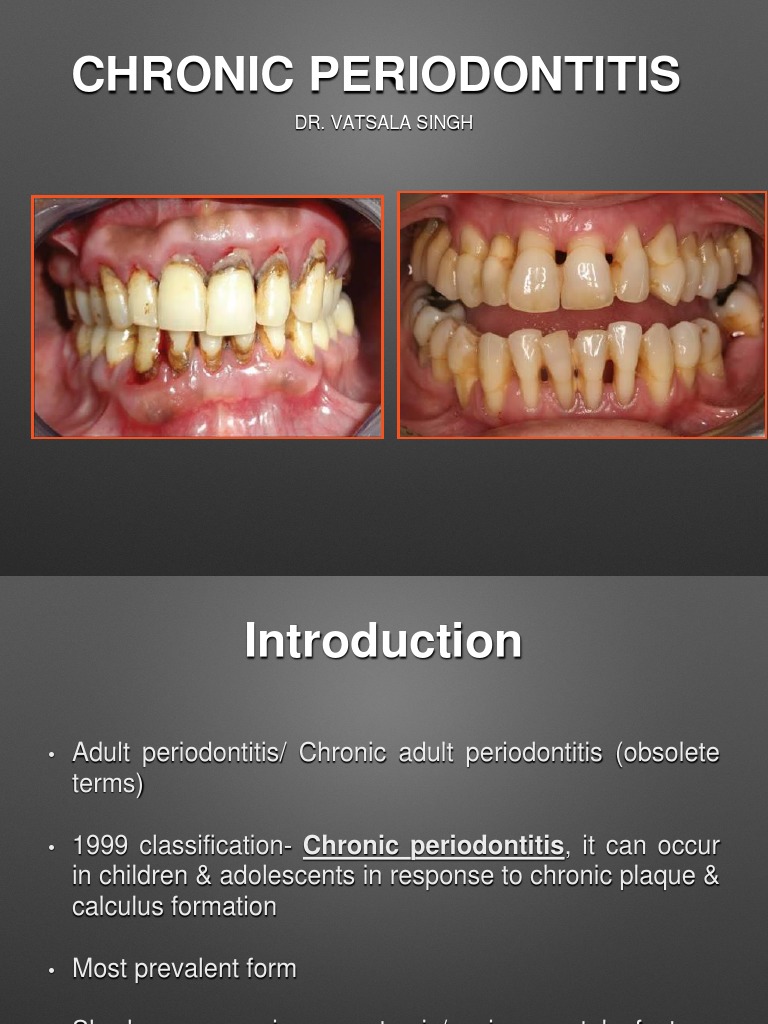 Chronic Periodontitis-Presented by DR Vatsala | PDF | Human Tooth ...
