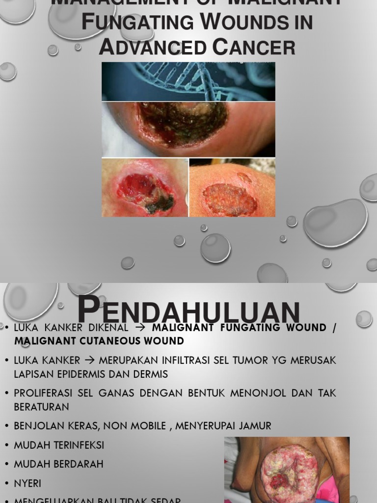 Fix Management of Malignant Fungating Wounds in Advanced Cancer | PDF ...