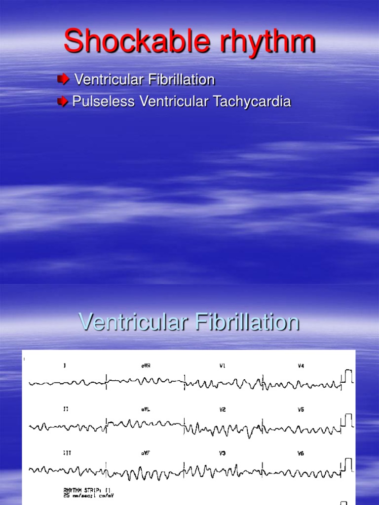 Shockable and Unshockable Rhytm | PDF