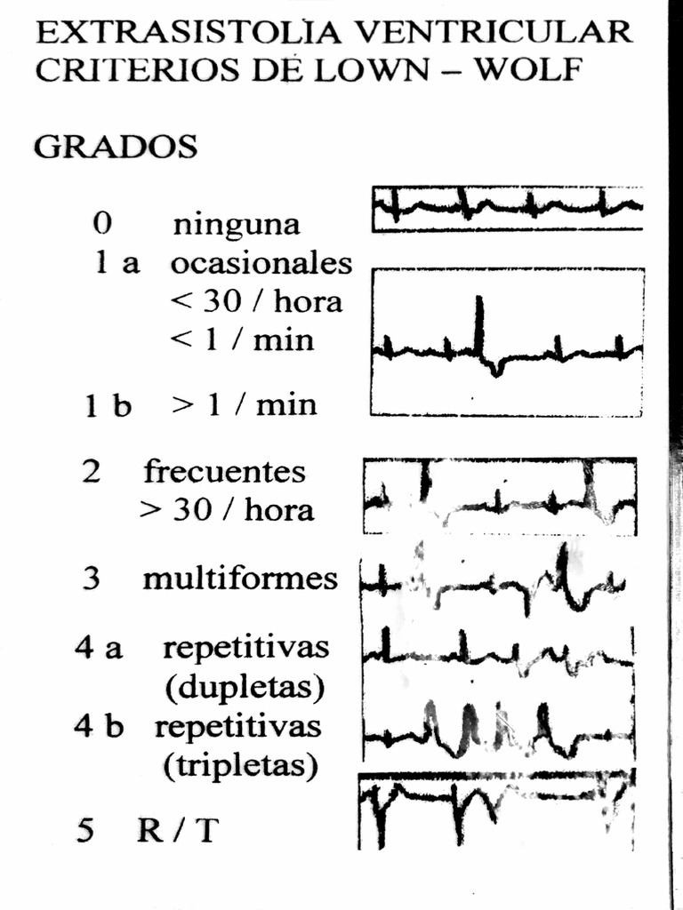 Criterios de Lown-Wolf | PDF