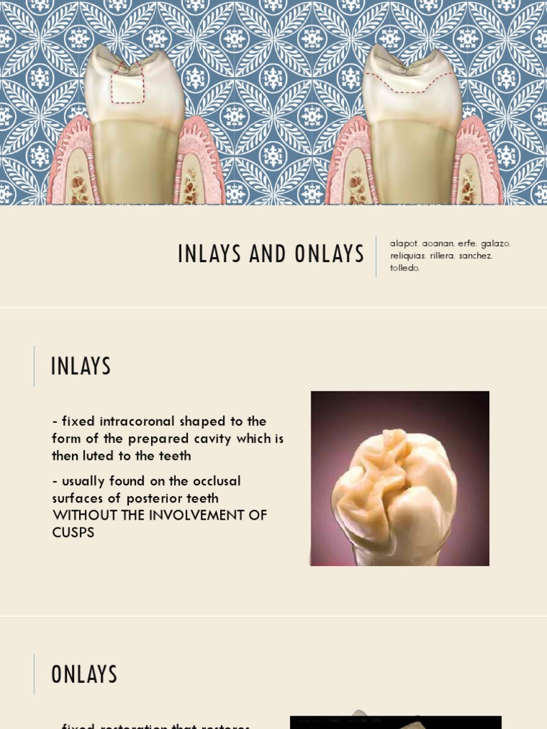 Inlays and Onlays | PDF | Mouth | Dentistry Branches