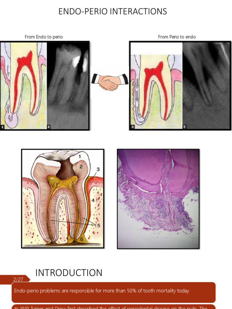 Endo Perio Lesions | PDF | Mouth | Dentistry