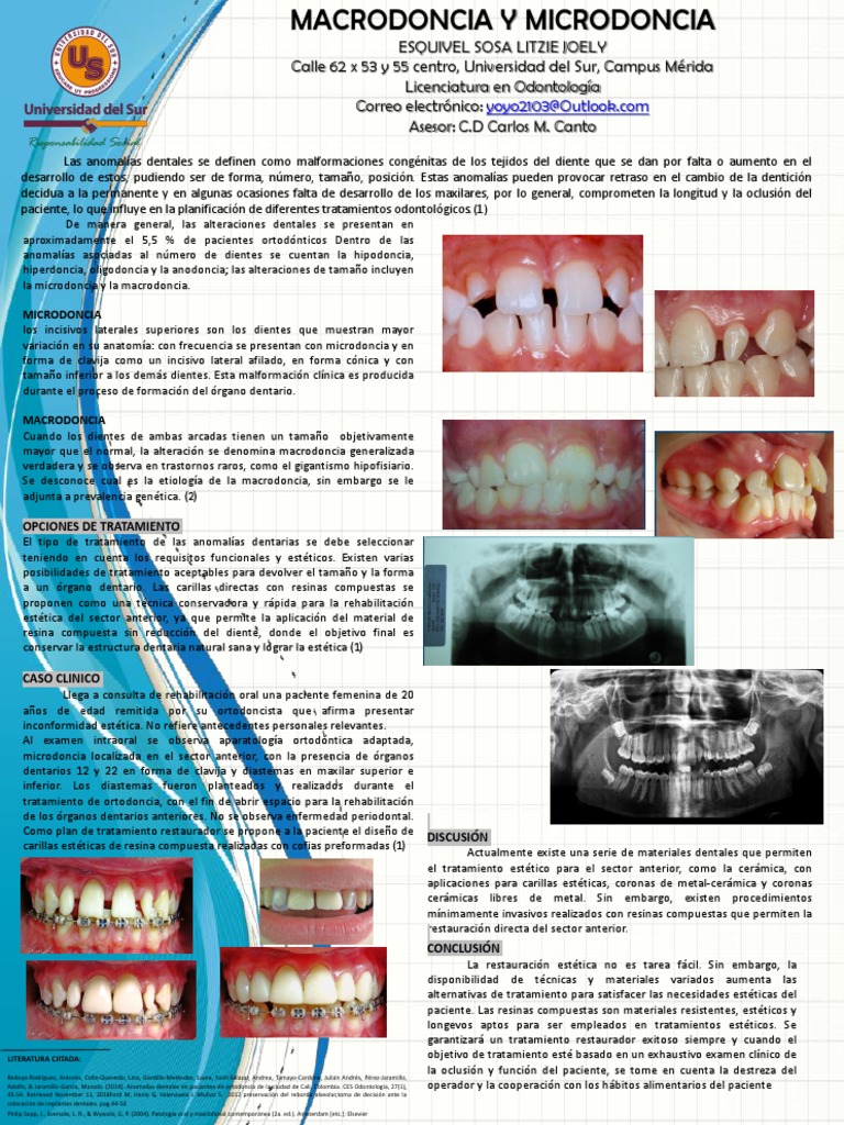 Tratamiento de microdoncia localizada mediante carillas estéticas de ...