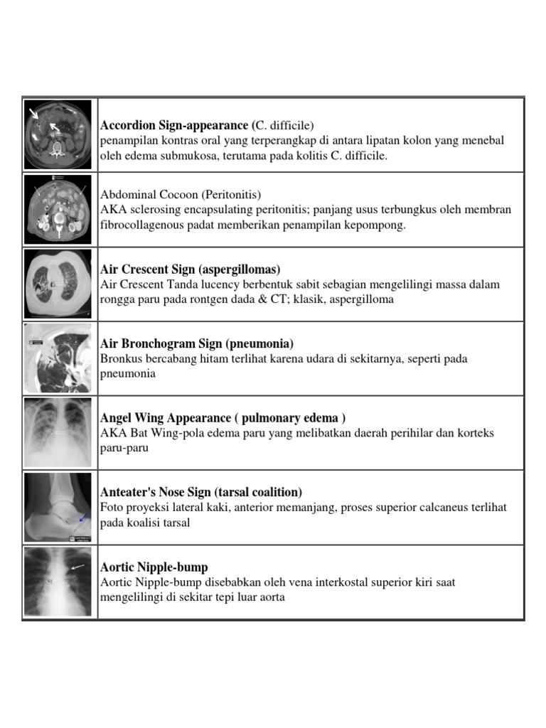 Accordion Sign-Appearance (C. Difficile) | PDF | Aorta | Lung