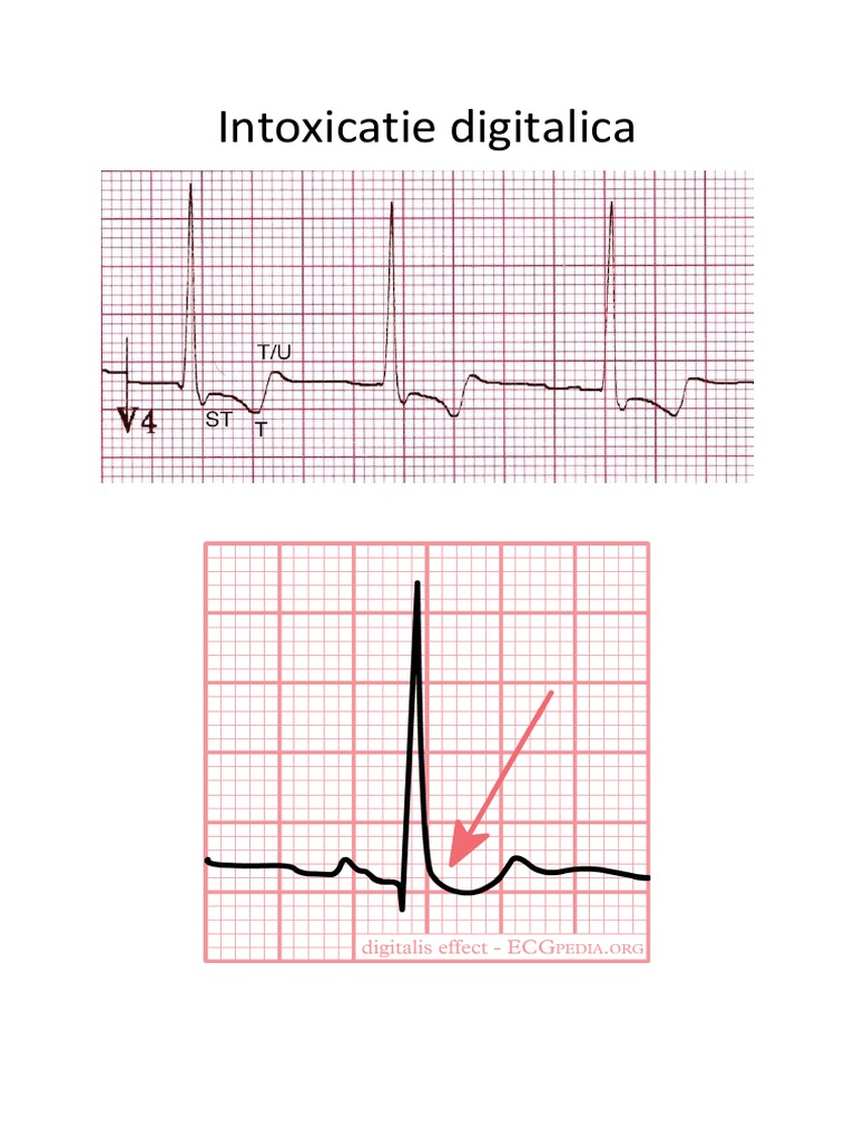 Intoxicatie Digitalica | PDF