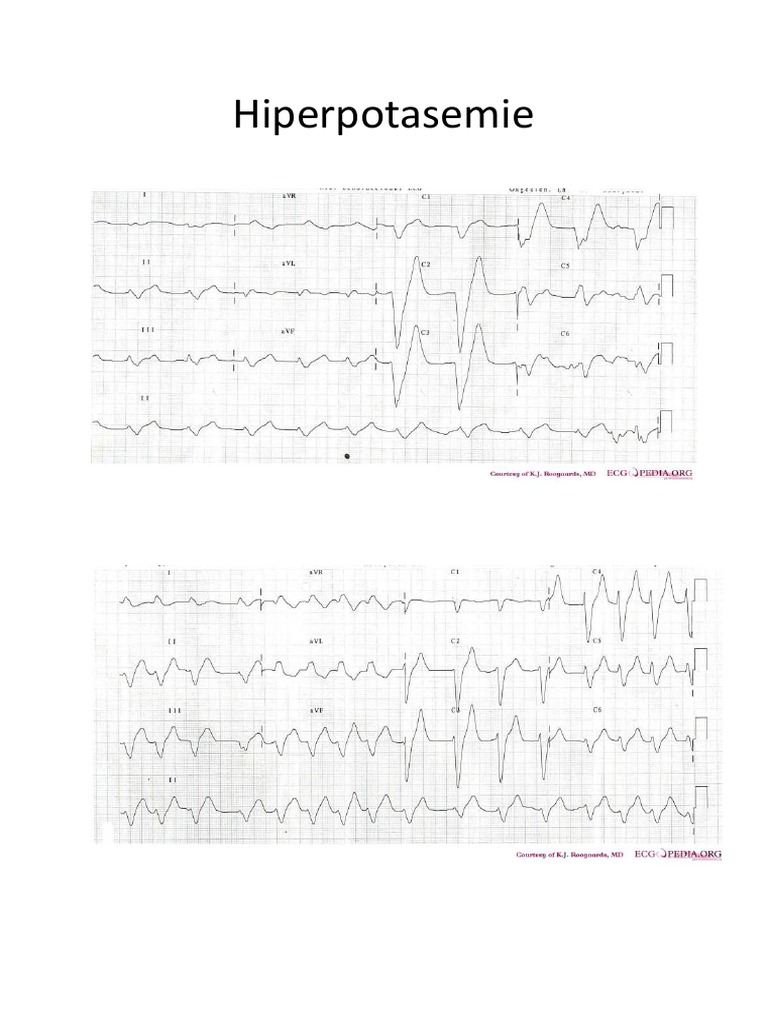 Hiperpotasemie ECG | PDF
