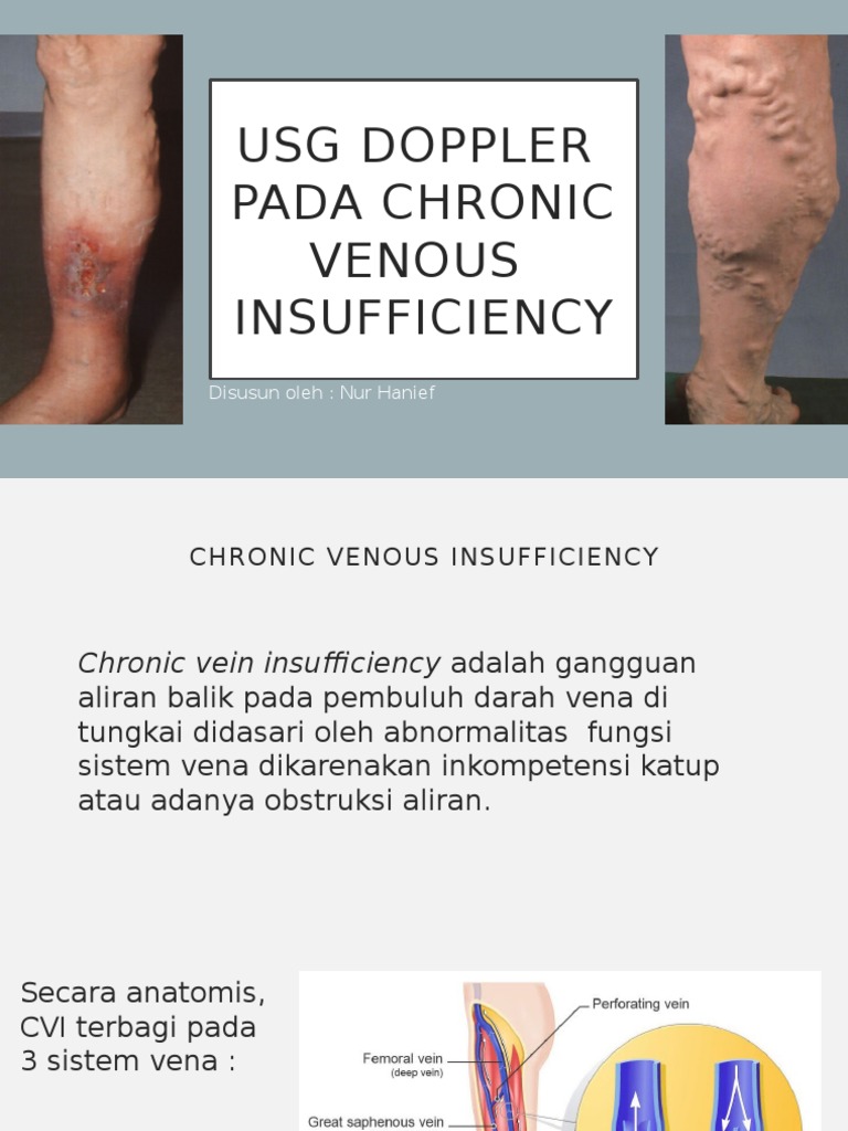 USG Doppler CVI | PDF