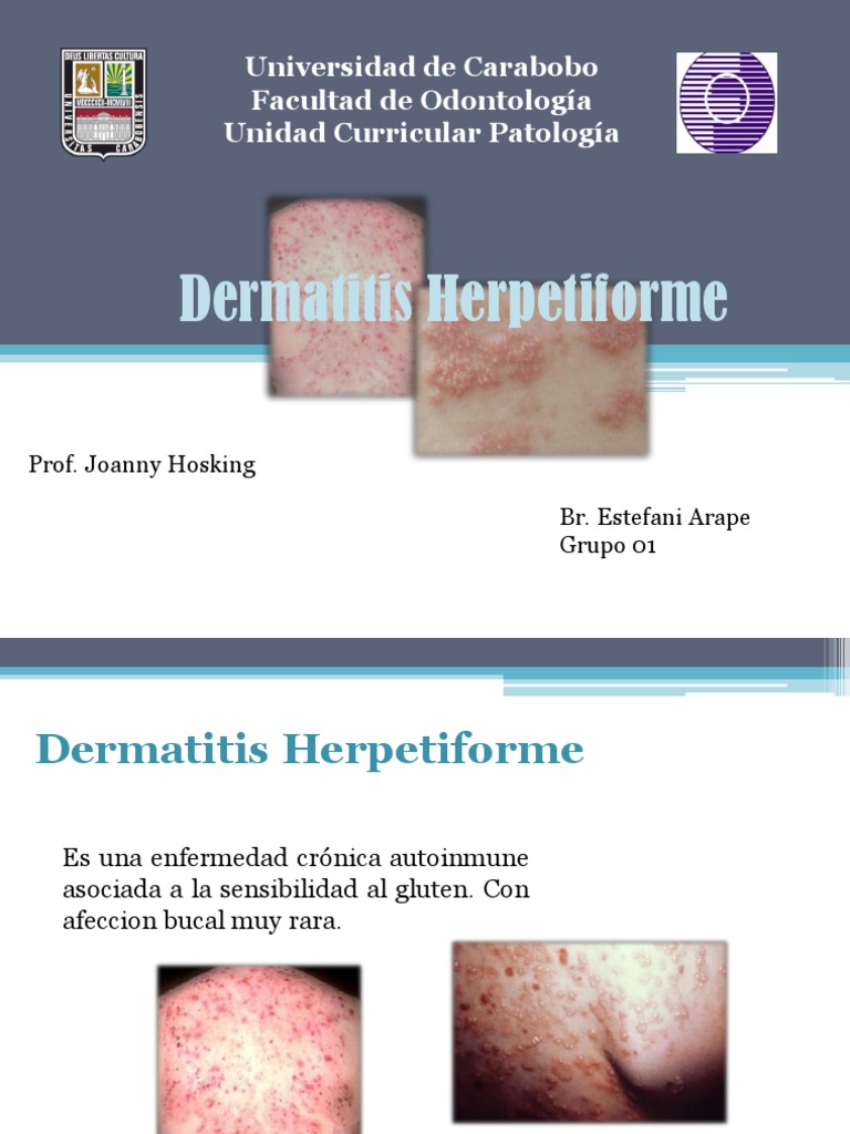 Dermatitis Herpetiforme Estudio | PDF | Epidemiología | Medicina CLINICA