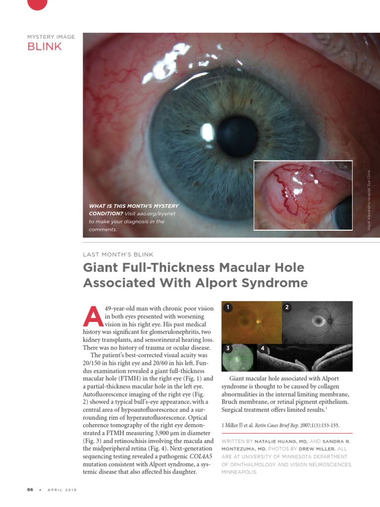April 2019 Blink | PDF | Eye | Ophthalmology
