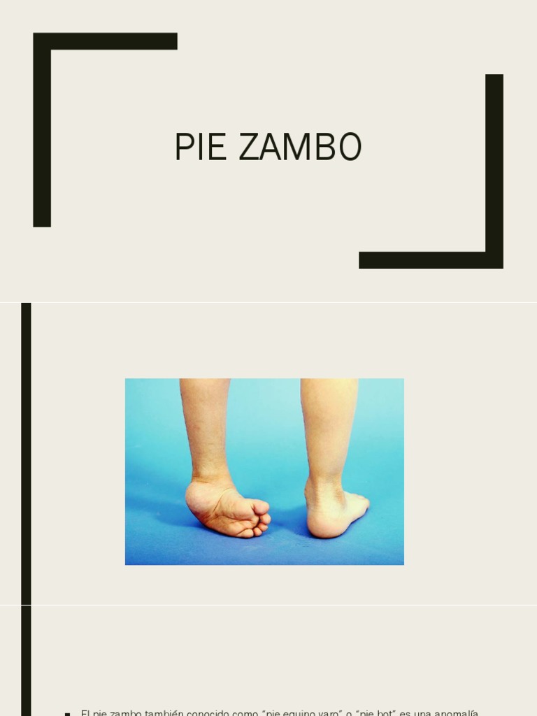 Pie Zambo | PDF | Medicina CLINICA | Enfermedades y trastornos