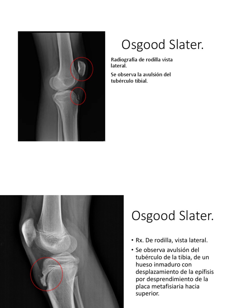 Osgood Slater.: Radiografía de rodilla vista lateral. Se observa la ...